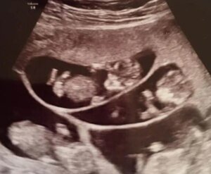 World’s First Septuplets Are Turning 27: This is How They Grew Up