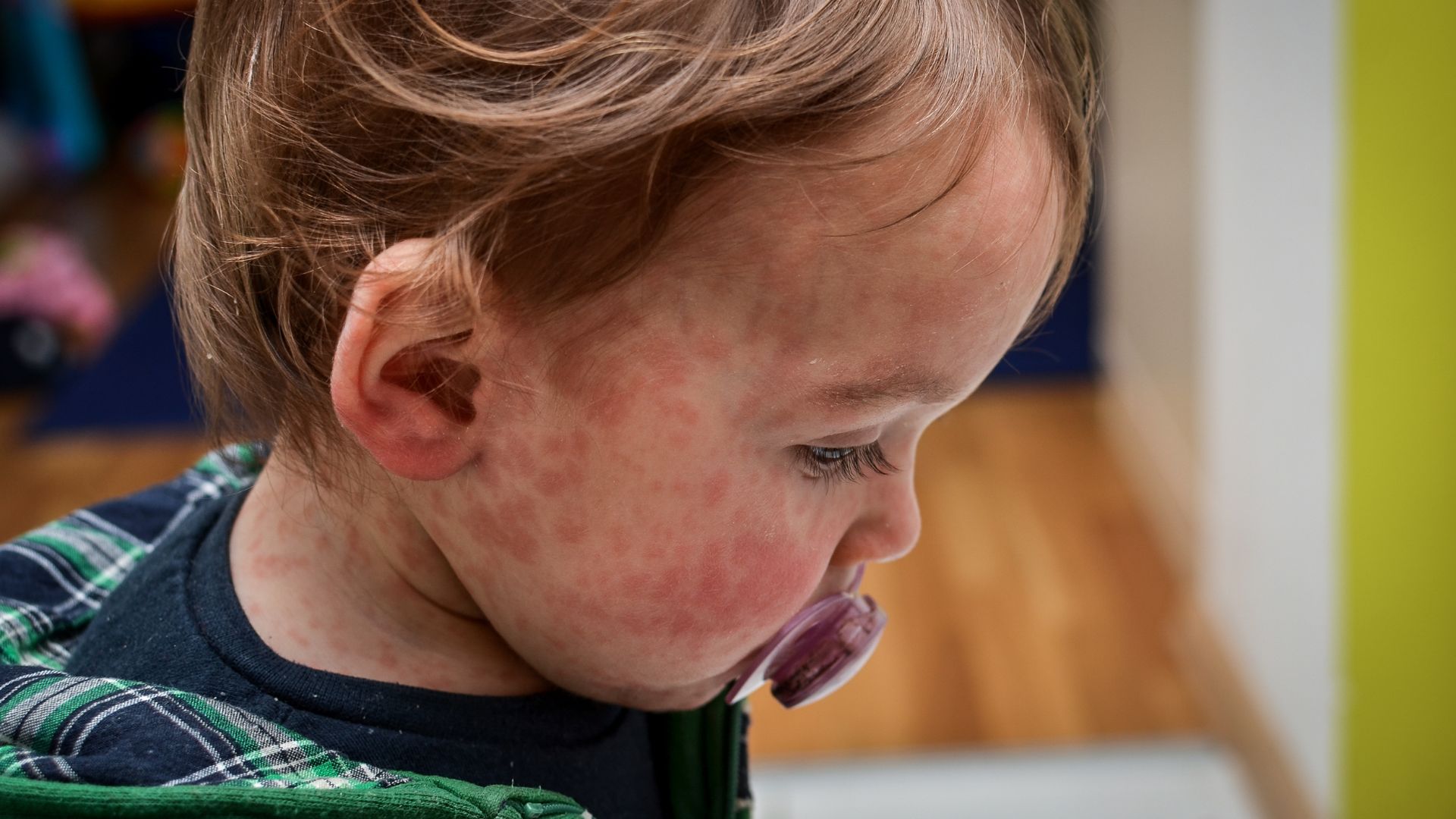 Measles Outbreak in South Carolina Climbs to 188 Cases - Blossom